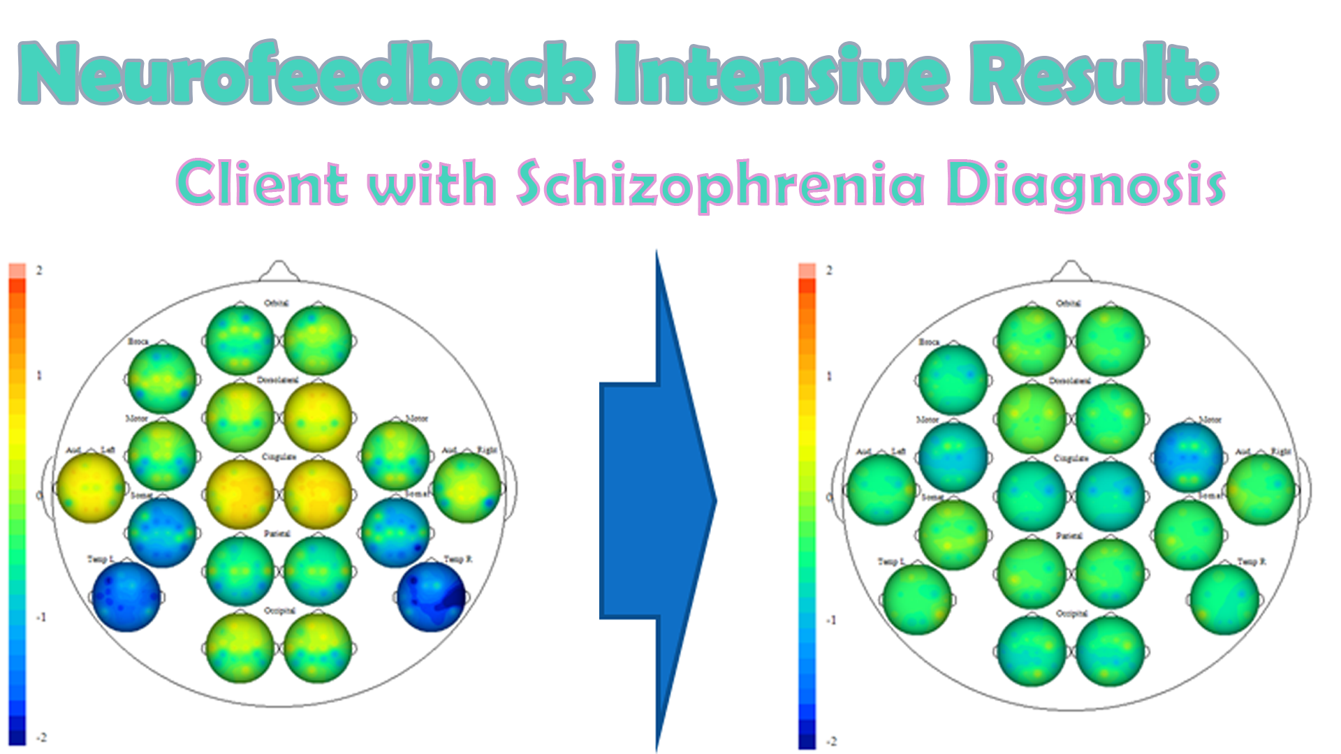 Neurofeedback for Rehabilitation, TBI, Stroke and Neurodegenerative ...