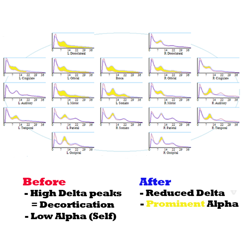 PTSD and Alpha Theta Neurofeedback Training - Neurofeedback London
